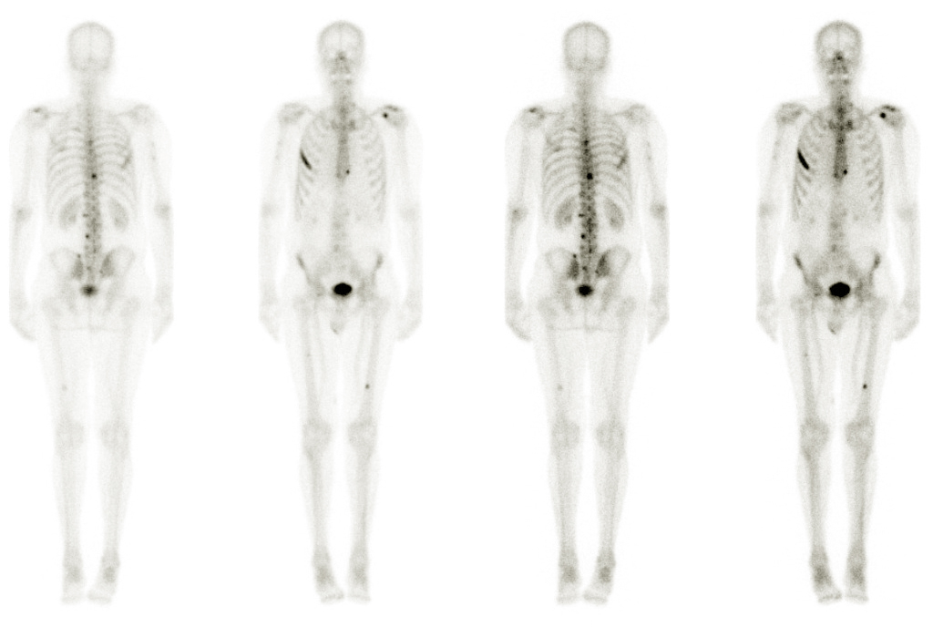 Bone Cancer Metastatic Cancer Cancer Metastasis Treatment